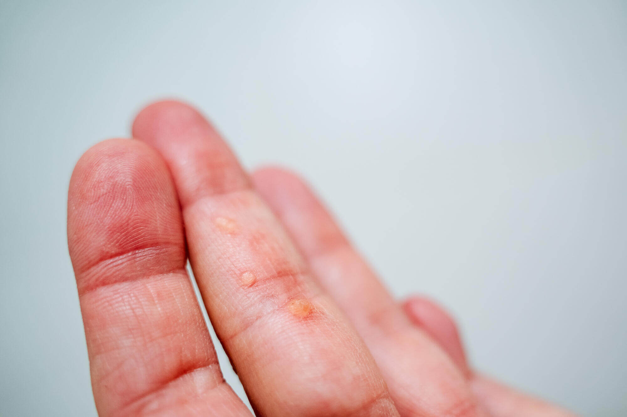 Effective Wart Removal Near Me: Top Treatment Options
